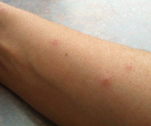 Punture di insetti negli umani: come comportarsi e quali rischi ci sono