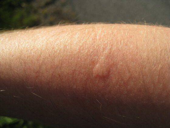 Punture di insetti negli umani: come comportarsi e quali rischi ci sono